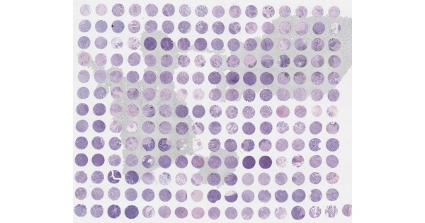 BR20810 Breast tumor tissue array (4 of 25), including TNM, clinical ...