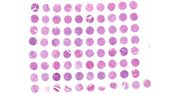 HN802-L67 Multiple head and neck tumor with normal tissue array ...
