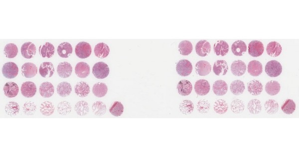 LC243a Lung cancer with lung tissue array (2015 WHOclassification ...