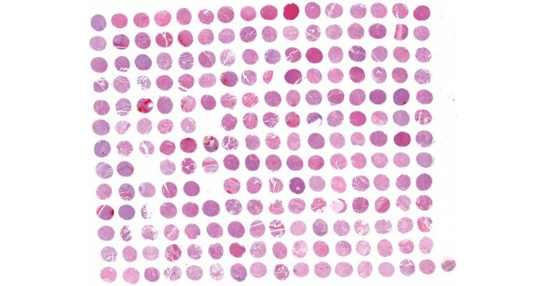 LV20810a Liver cancer survey tissue array (2 of 3), including TNM and ...