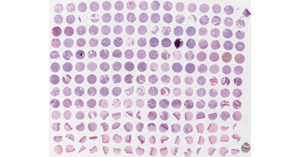 SK2081 Skin disease spectrum (dermatic cancer progression) tissue array ...