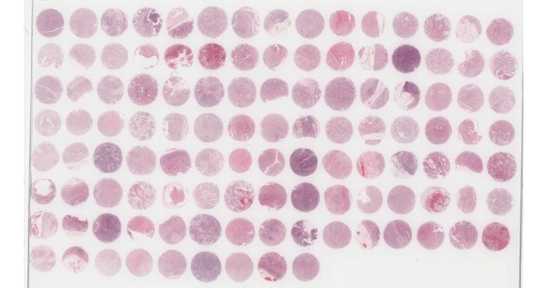 ST1141 Advanced stomach carcinoma with matched adjacent normal stomach ...