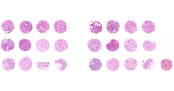 T054-L32 Colonrectal cancer tissue array with normal colonrectal tissue ...