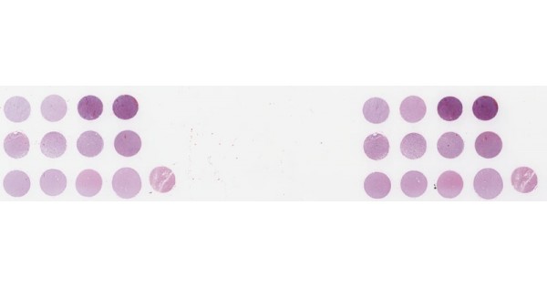 T173b Cerebrum cancer tissue array, with normal tissue, including ...