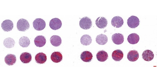 T322 Spleen tumor with normal spleen tissue control test tissue array ...